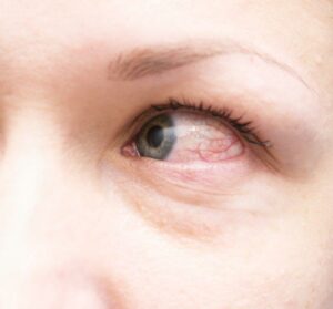 Many Causes of Red Eye | Metrolina Eye Associates