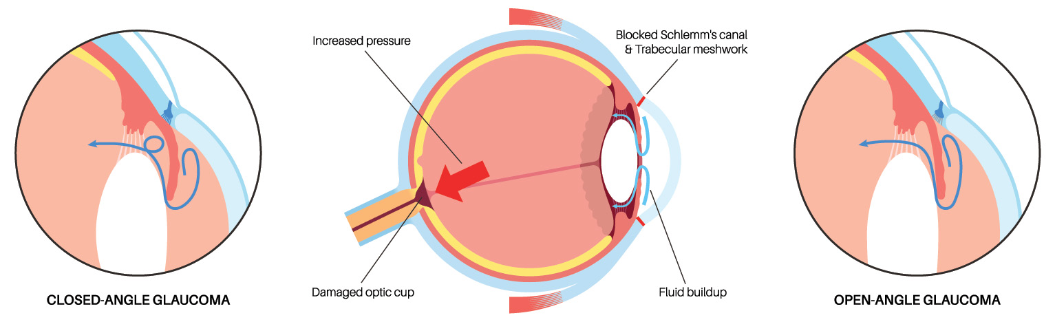 Glaucoma Treatment Charlotte | Glaucoma Surgery Rock Hill | MEA