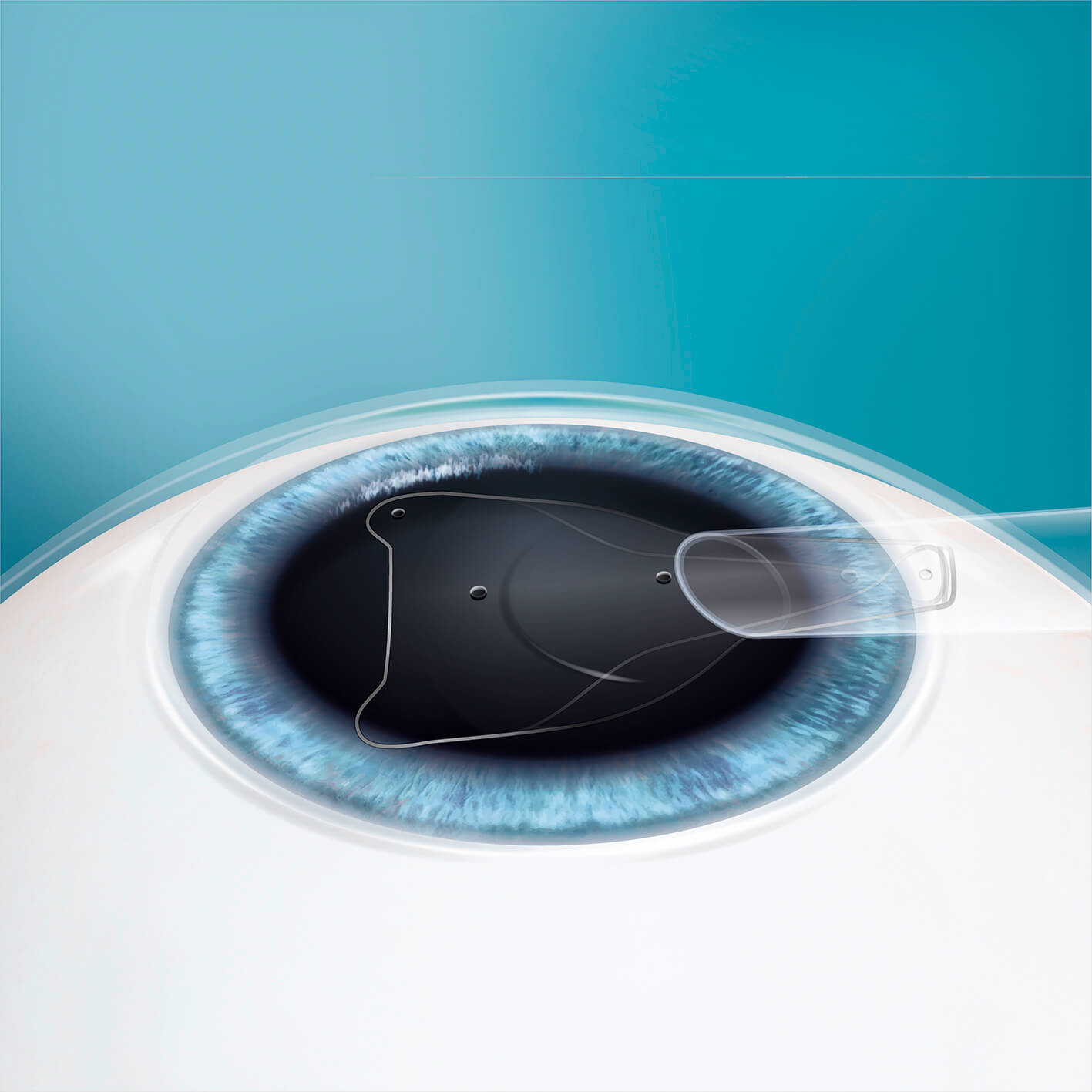 EVO ICL Charlotte | Vision Correction Rock Hill, NC | Metrolina Eye